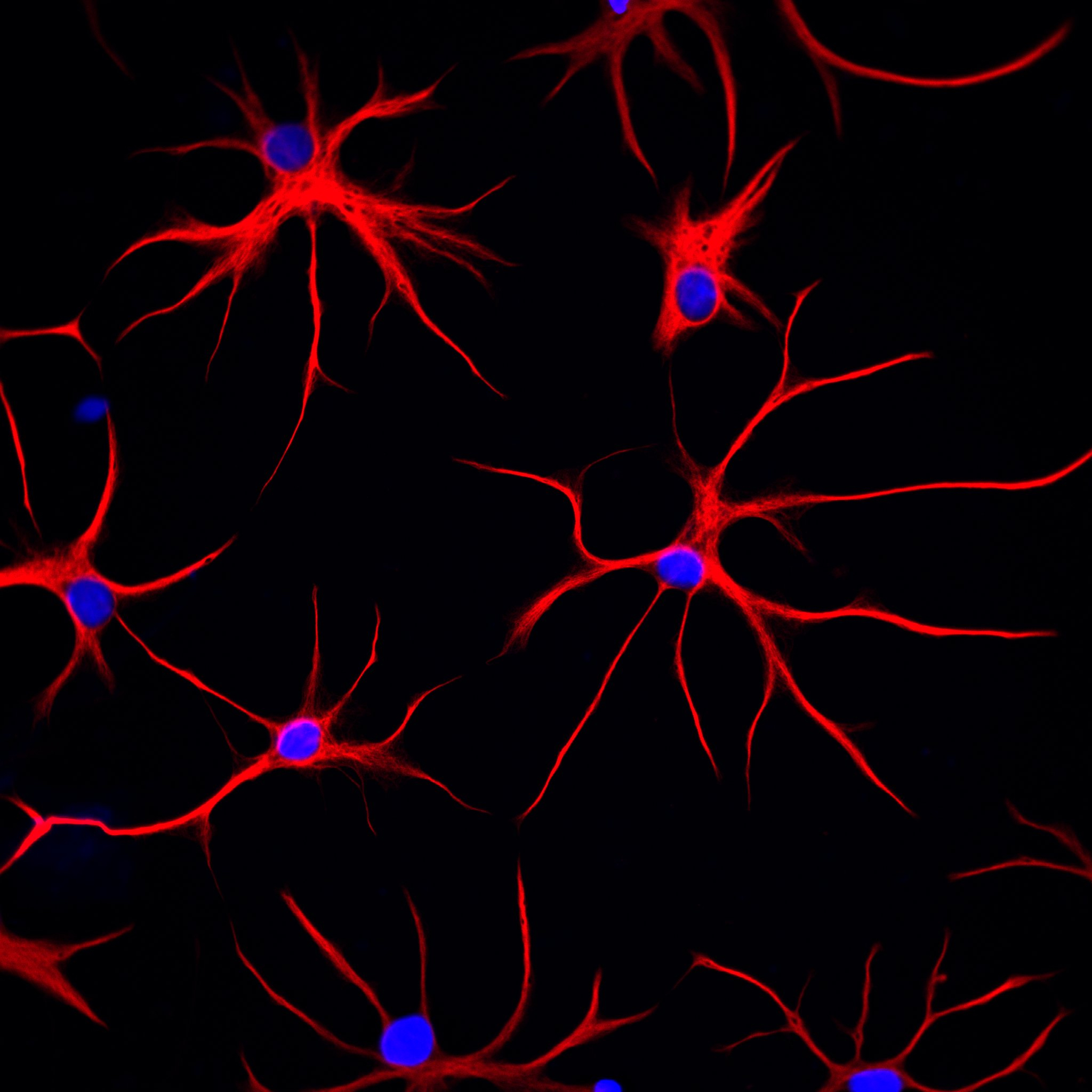 Mutation In Common Protein Triggers Tangles Chaos Inside Brain Cells