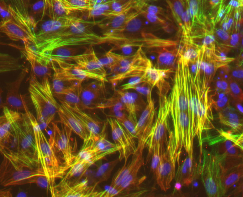 UW–Madison researchers find hidden genetic clues upping cardiovascular ...